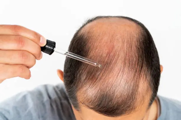 "Hair Fall: Causes, Solutions, and Prevention"